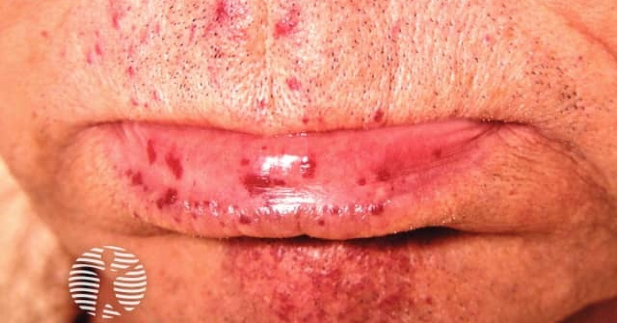 Hereditary haemorrhagic telangiectasia image