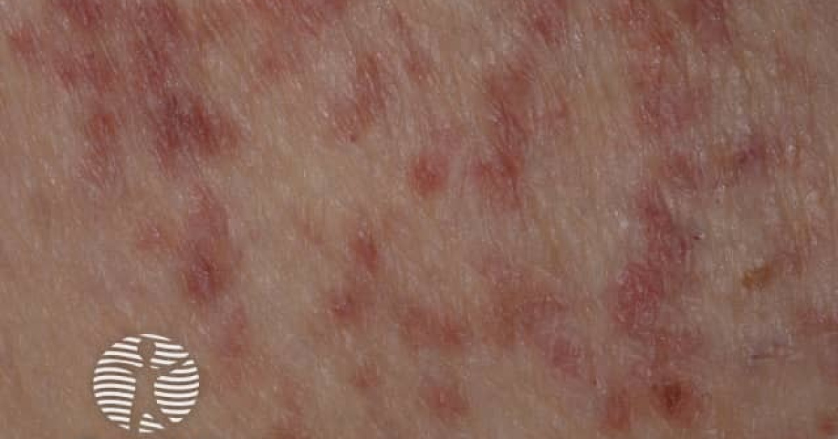 Telangiectasia macularis eruptiva perstans image