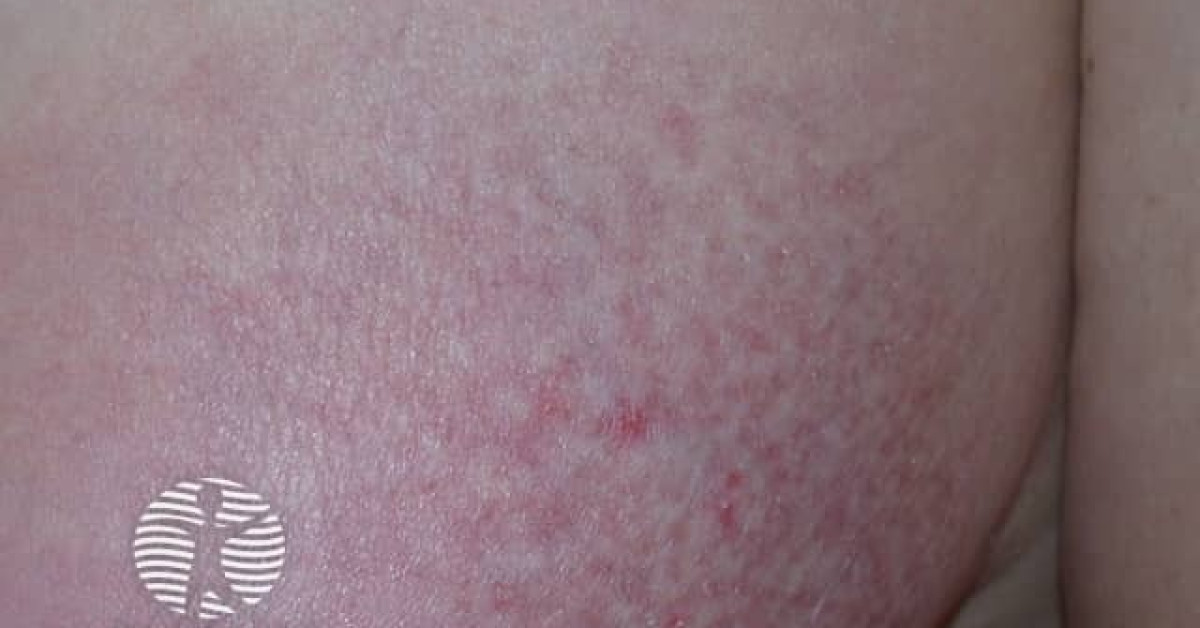 Telangiectasia in poikiloderma vasculare atrophicans CTCL image