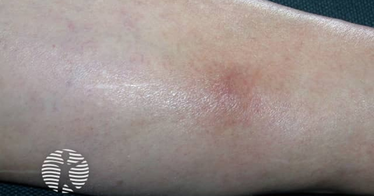 Superficial thrombophlebitis image