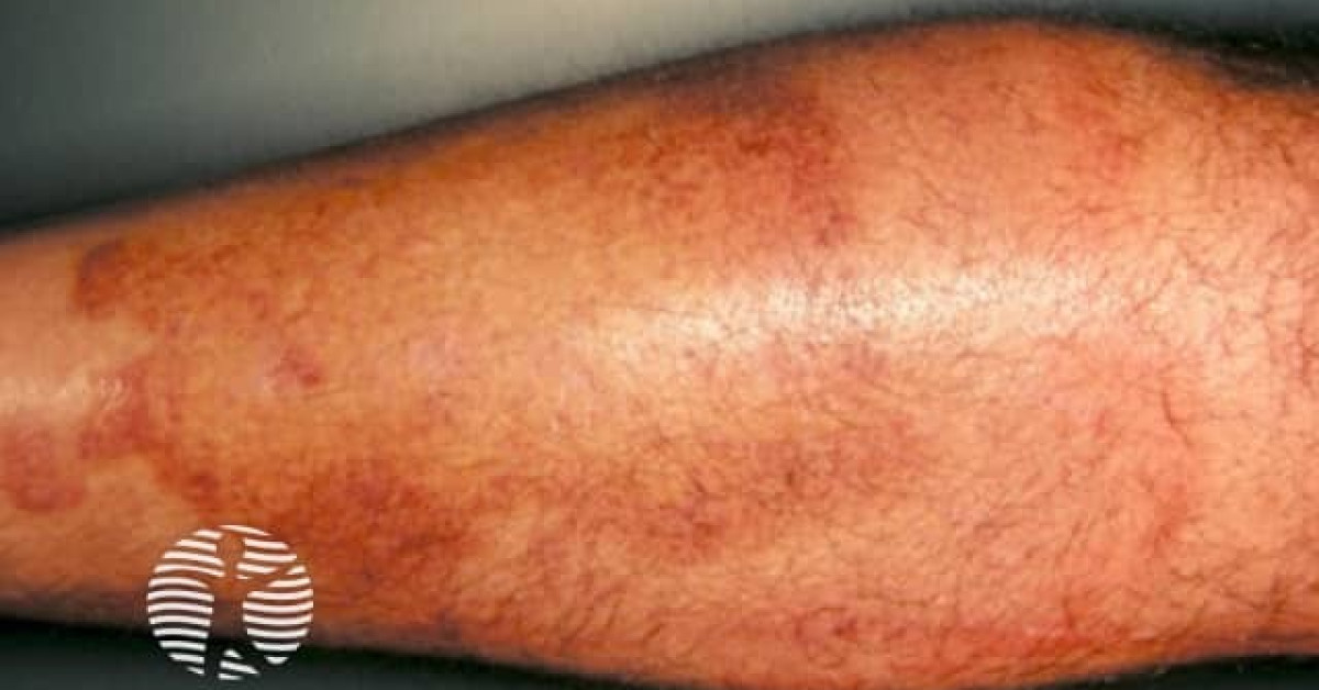 Urticarial vasculitis image