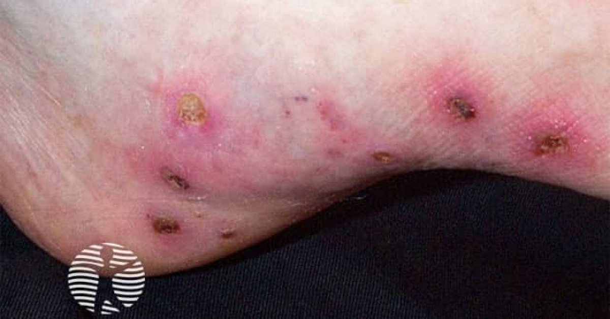 Cutaneous vasculitis image