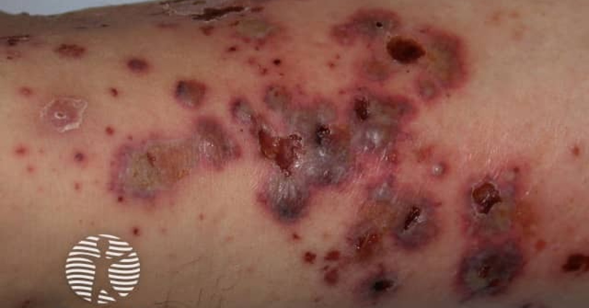 Cutaneous vasculitis image