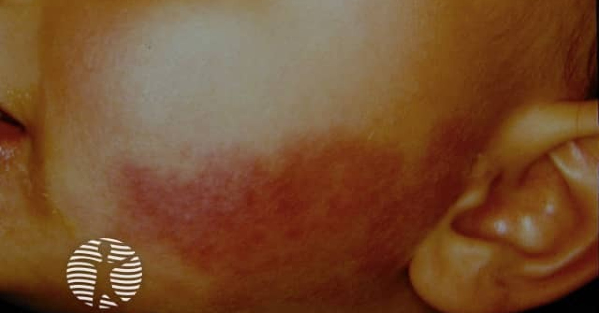 DermNet® - Vascular malformation image