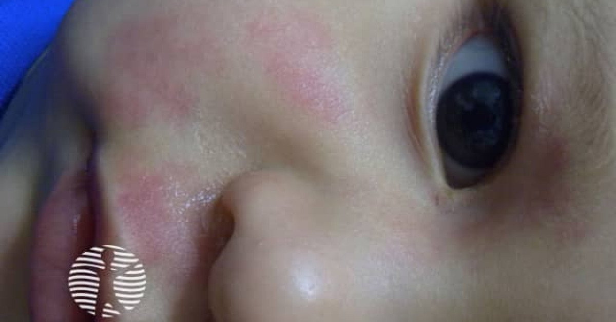 Vascular malformation image