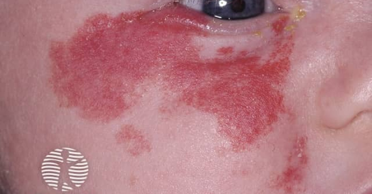 Vascular malformation image