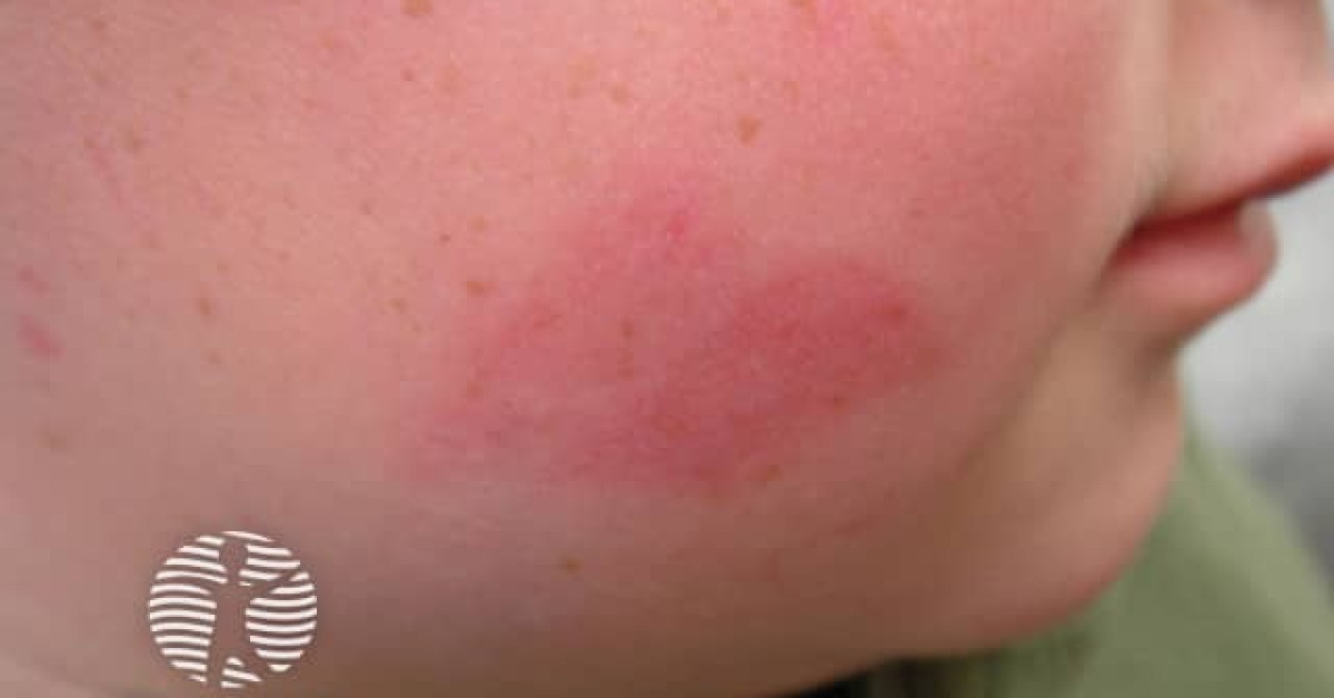 Vascular malformation image