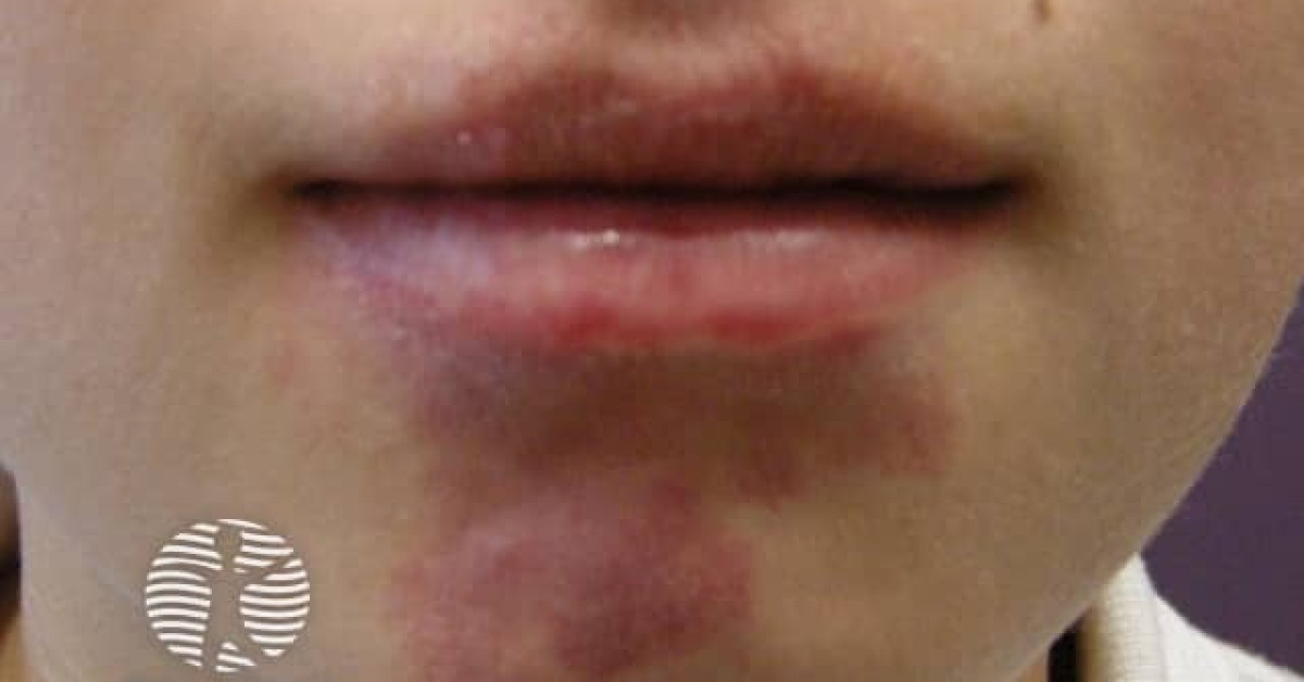 Vascular malformation image