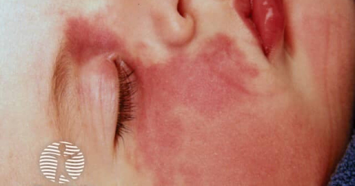 Vascular malformation image