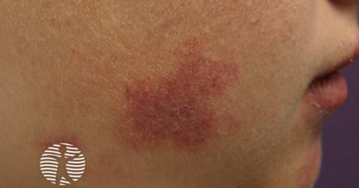 Vascular malformation image