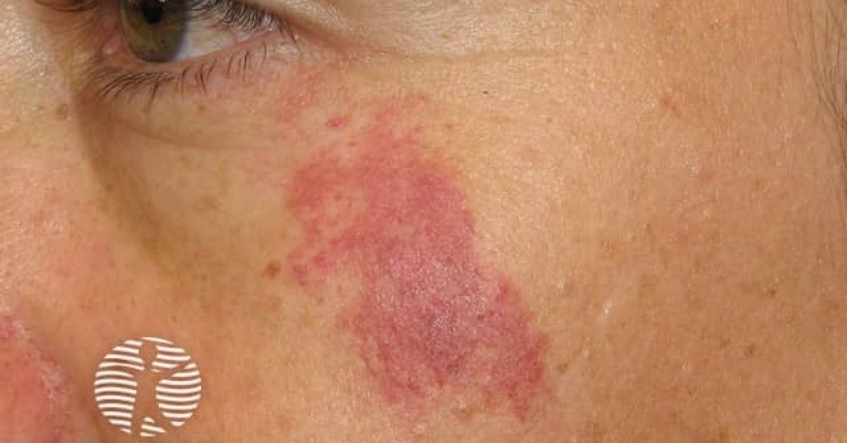 Vascular malformation image