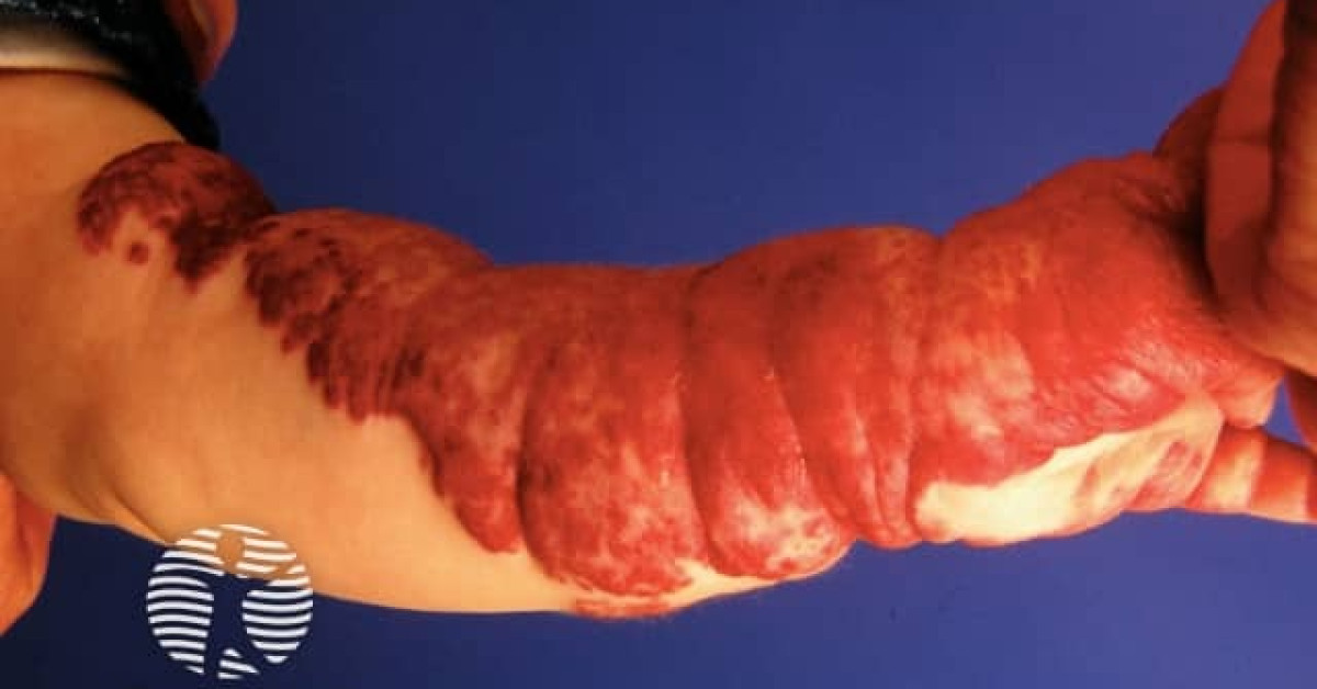 Vascular malformation image