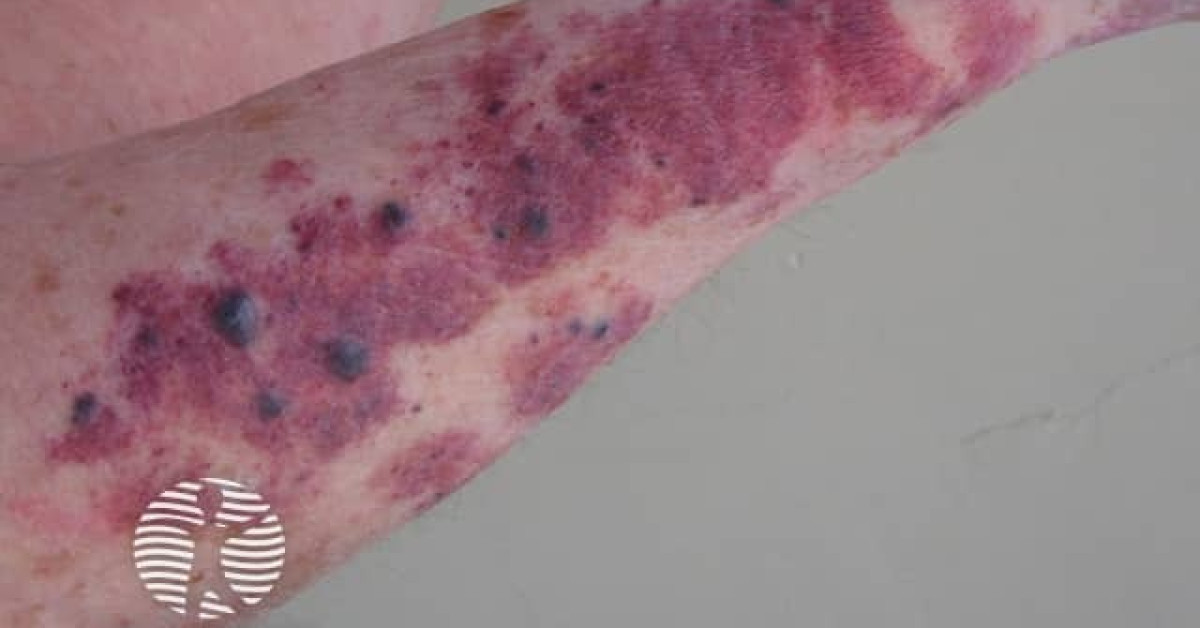 DermNet® - Vascular malformation image