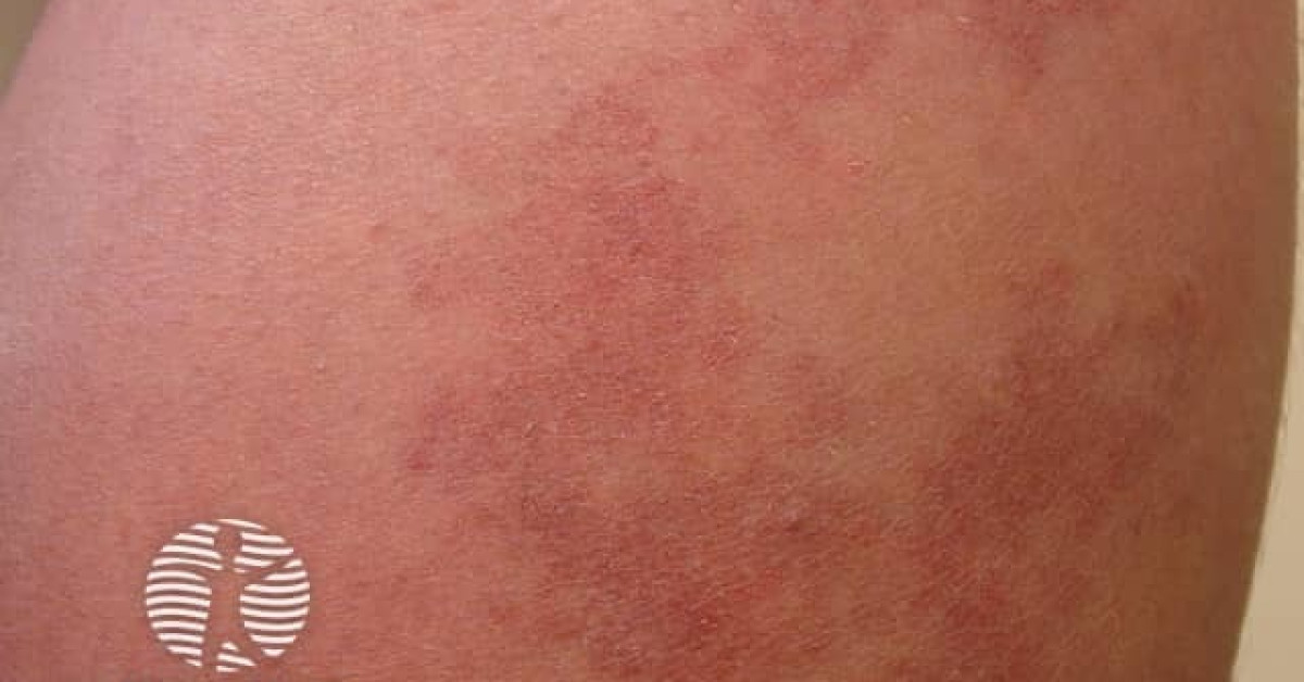 Vascular malformation image