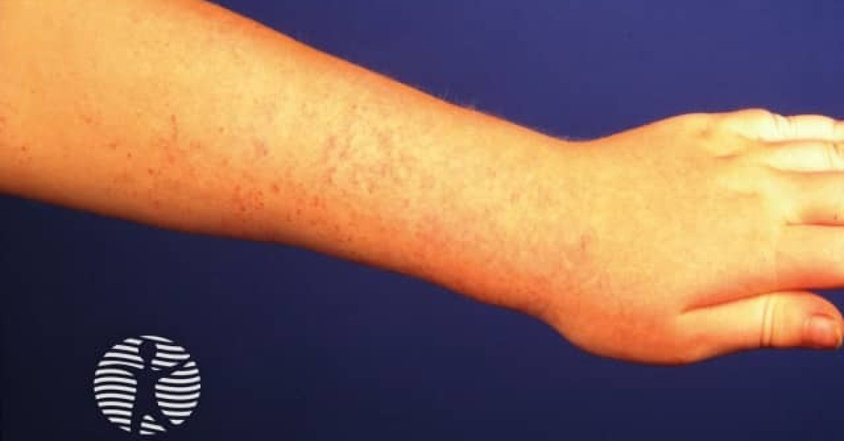 Vascular malformation image