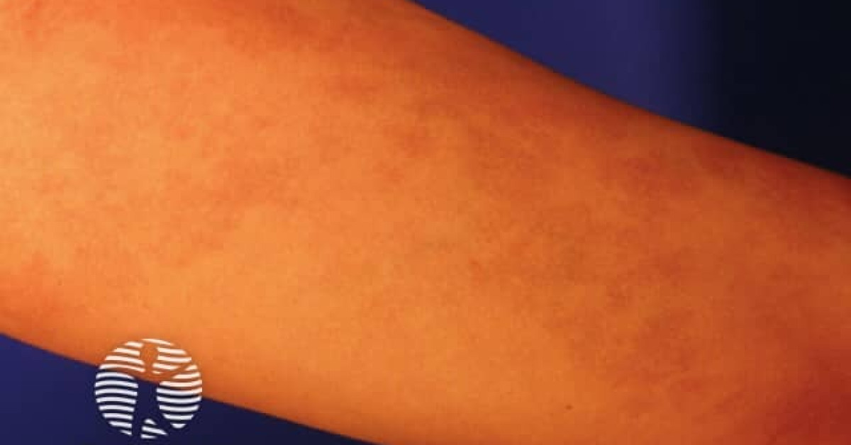 DermNet® - Vascular malformation image