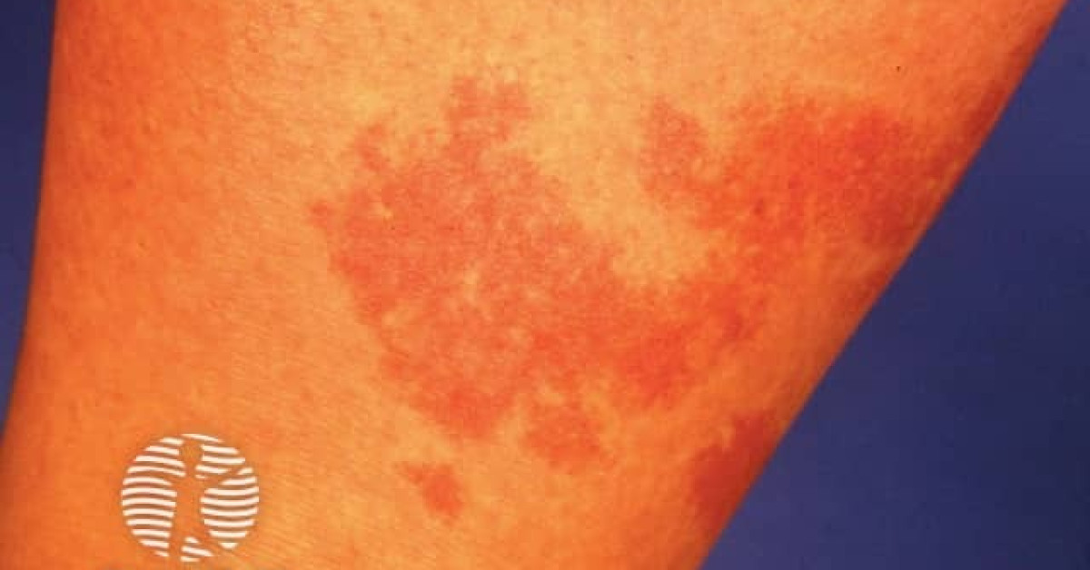 Vascular malformation image