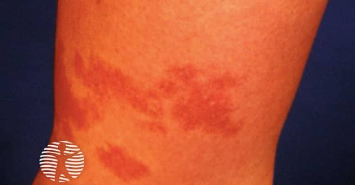 Vascular malformation image