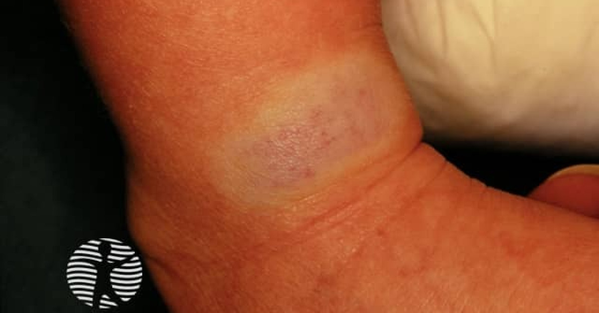 Vascular malformation image