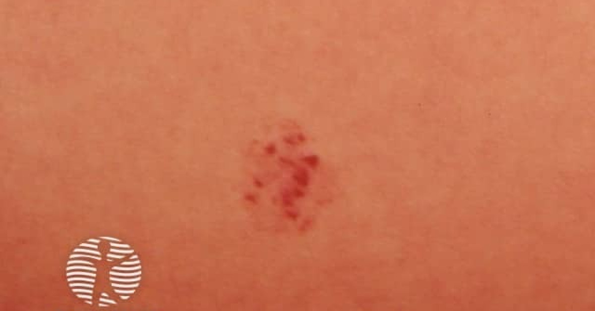 Vascular malformation image