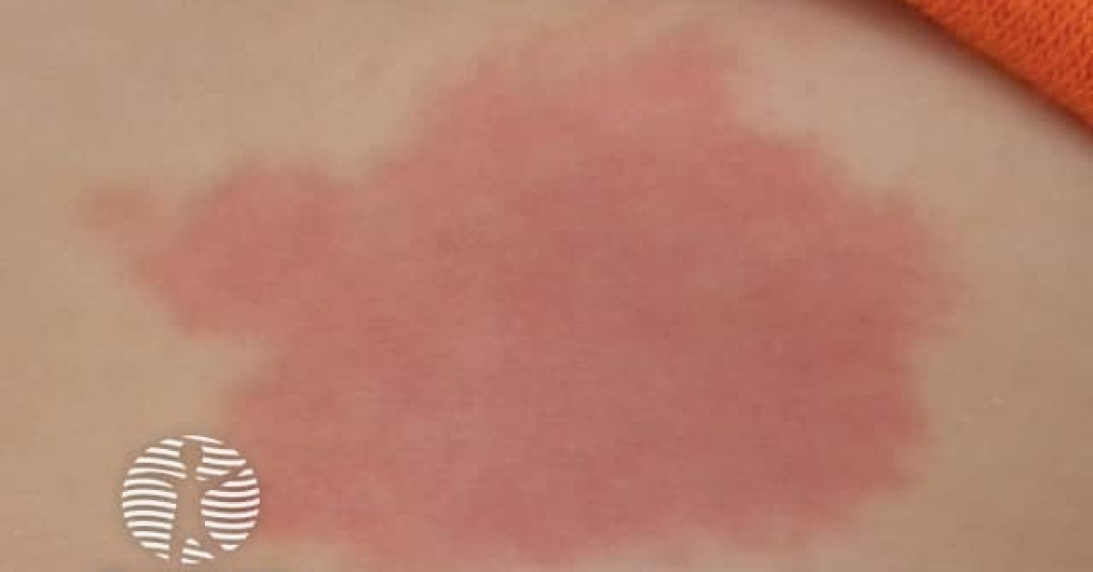 Vascular malformation image