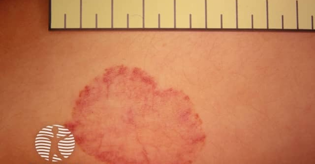 Vascular malformation image