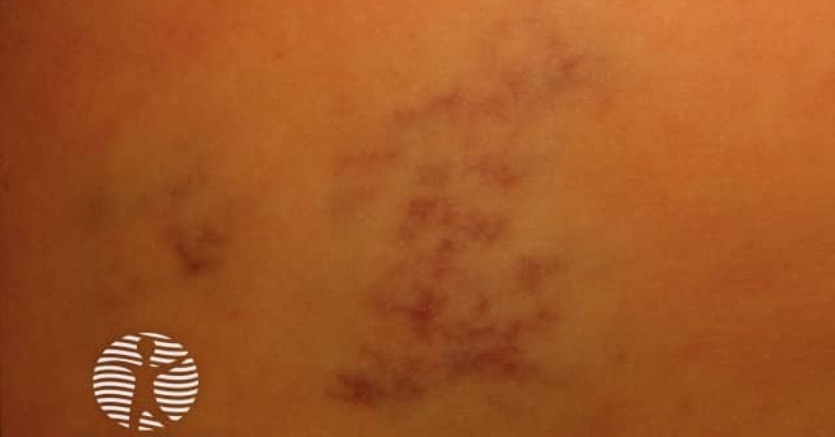 Vascular malformation image