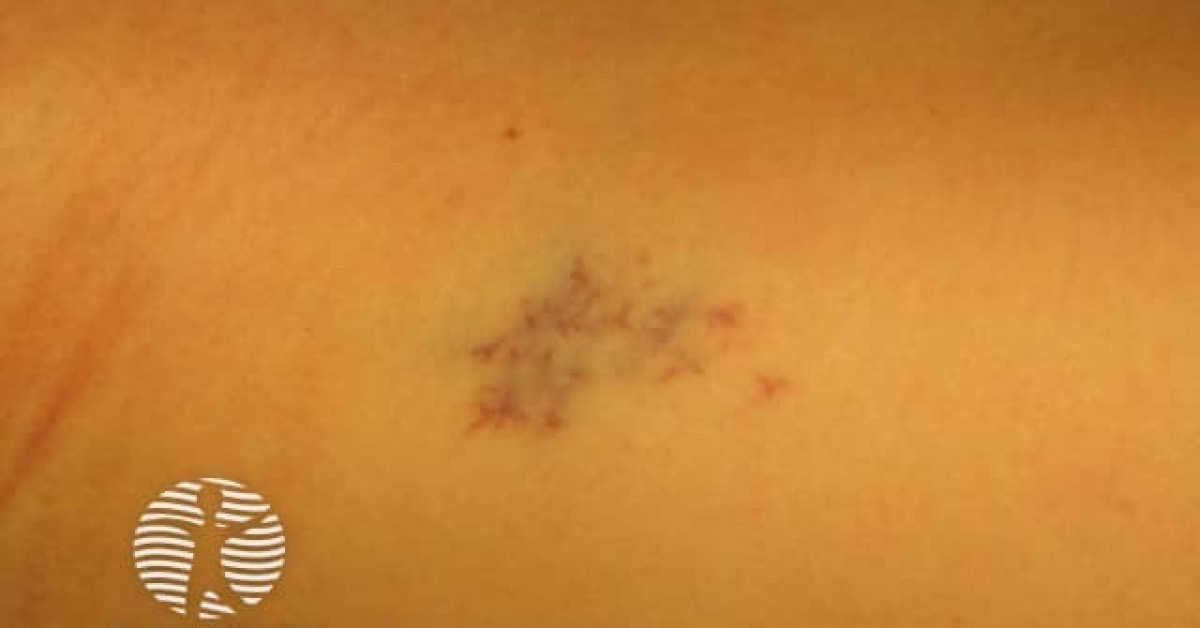 Vascular malformation image