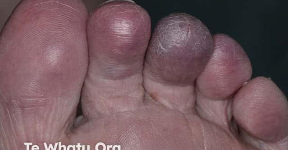 Secondary acrocyanosis image