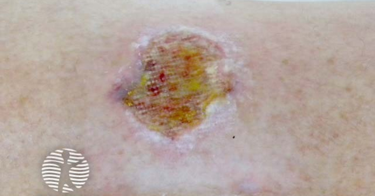 Martorell ulcer image