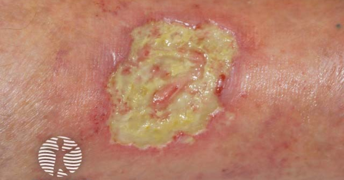 Martorell ulcer image
