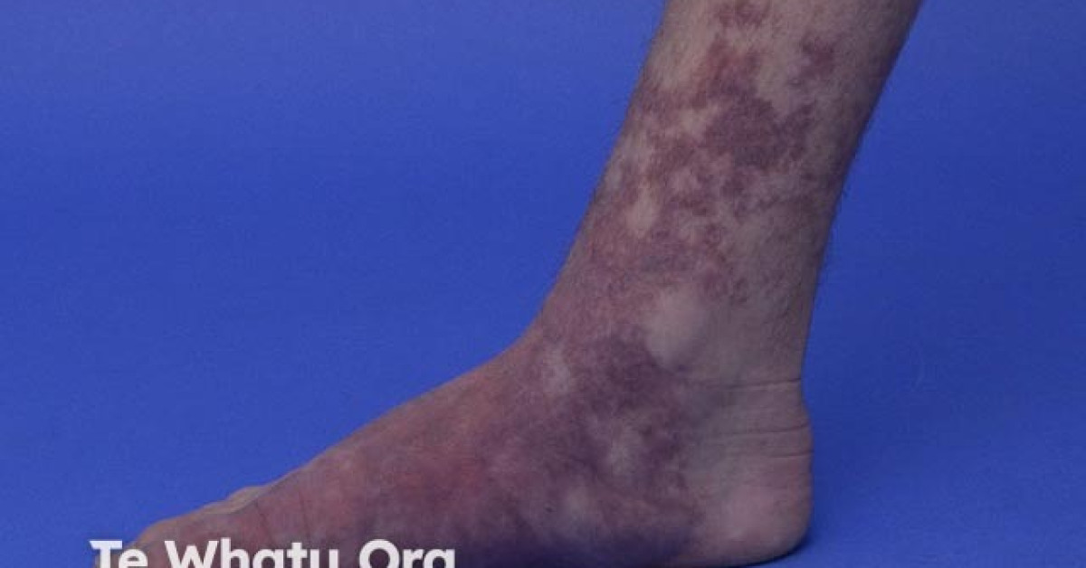 Capillary vascular malformation image