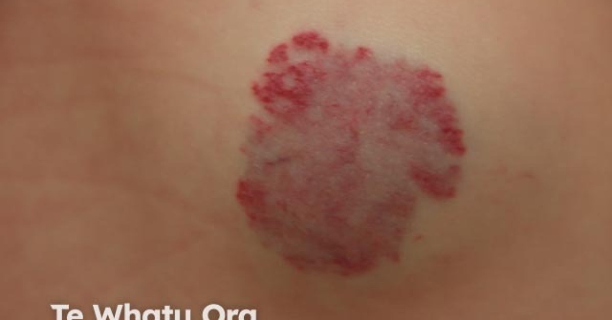 DermNet® - Infantile haemangioma image