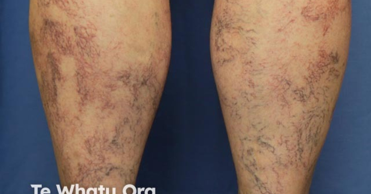 Essential telangiectasia image