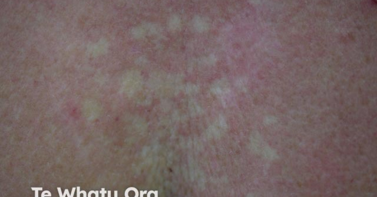 Naevus anaemicus image