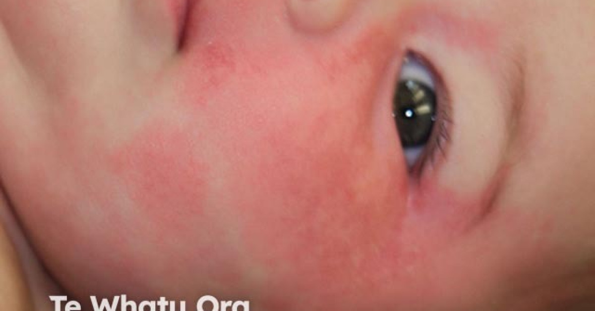 DermNet® - Vascular malformation image