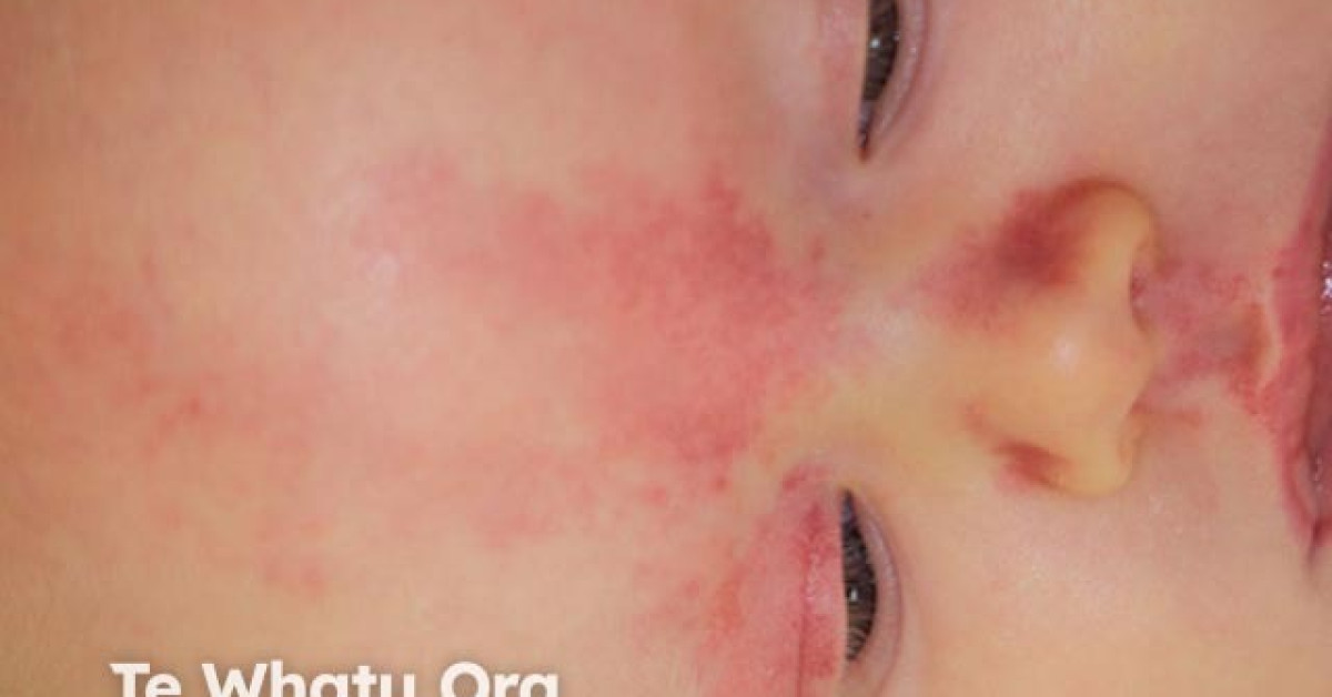 DermNet® - Vascular malformation image