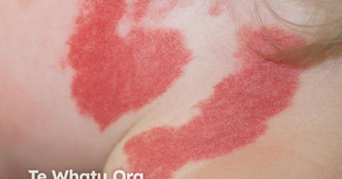 Vascular malformation image