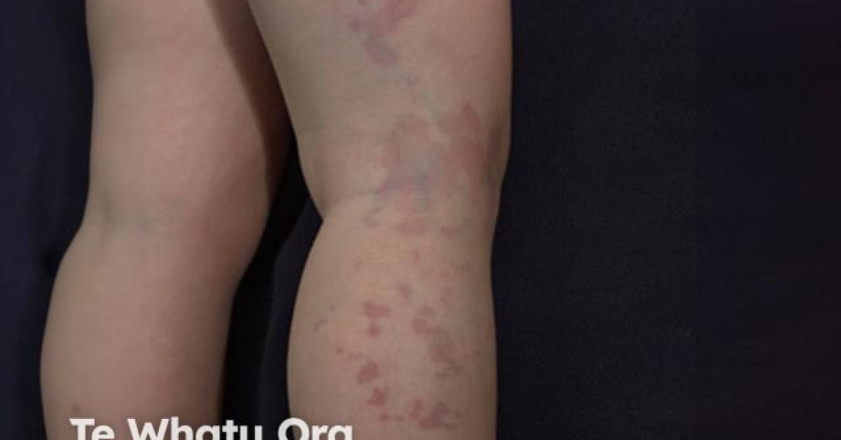 Vascular malformation image