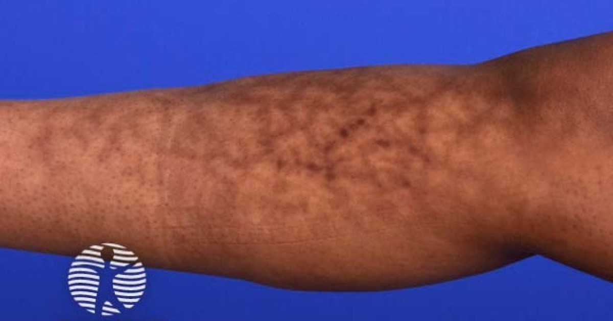 Livedo reticularis image