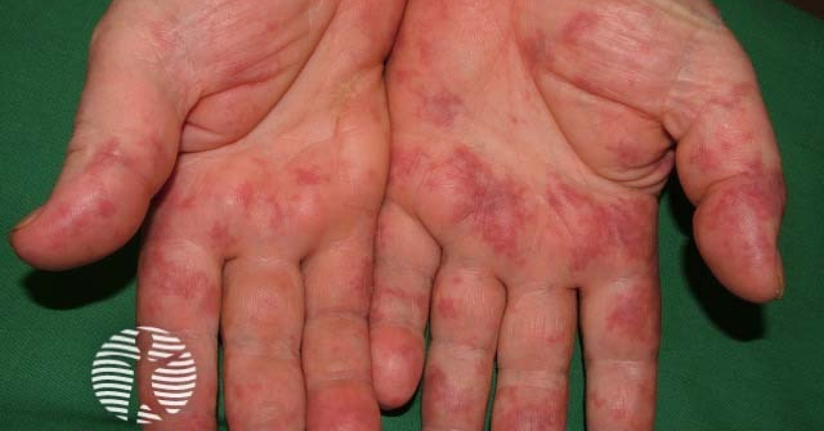 Vasculitis due to cryoglobulinaemia image