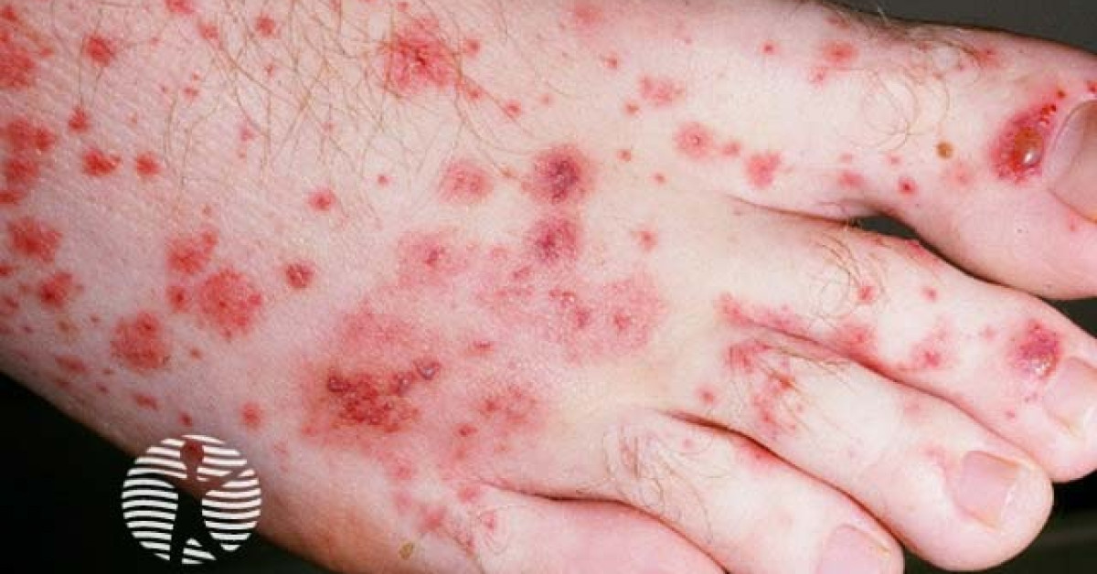 Small vessel vasculitis image