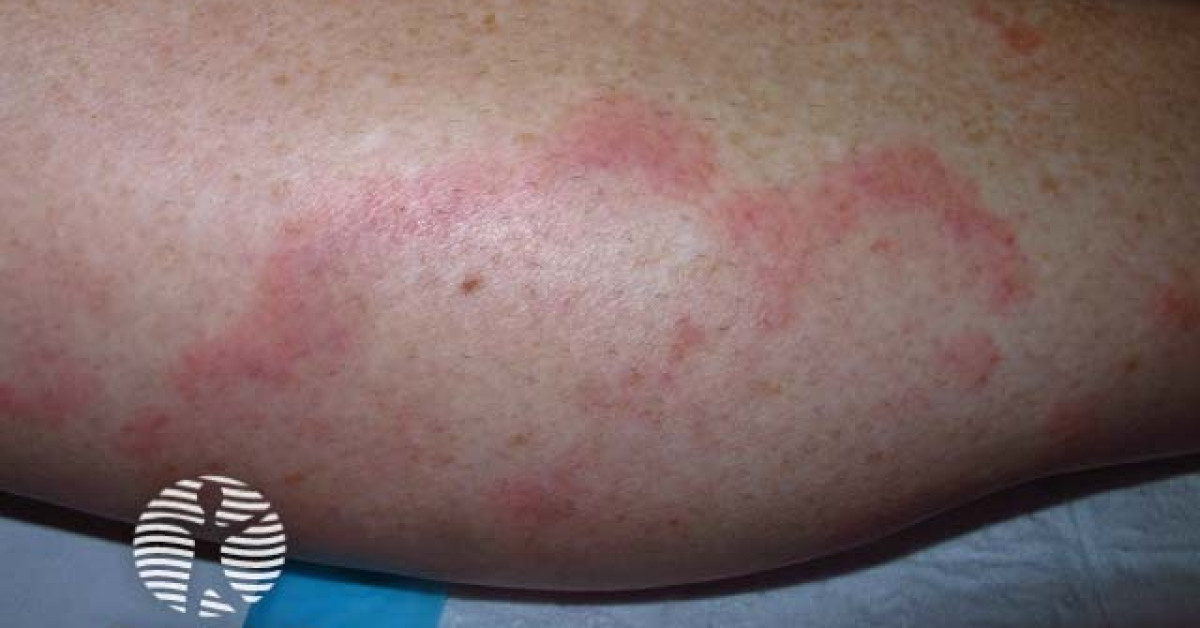 Urticarial vasculitis image