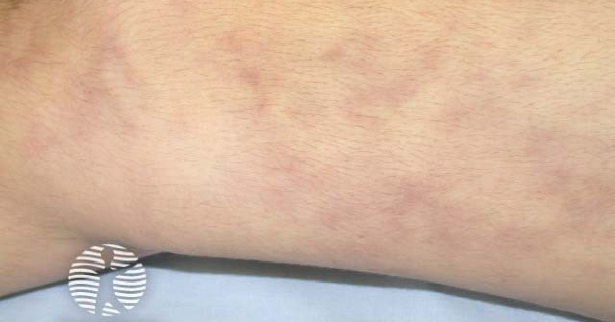 Livedo reticularis in polyarteritis nodosa image