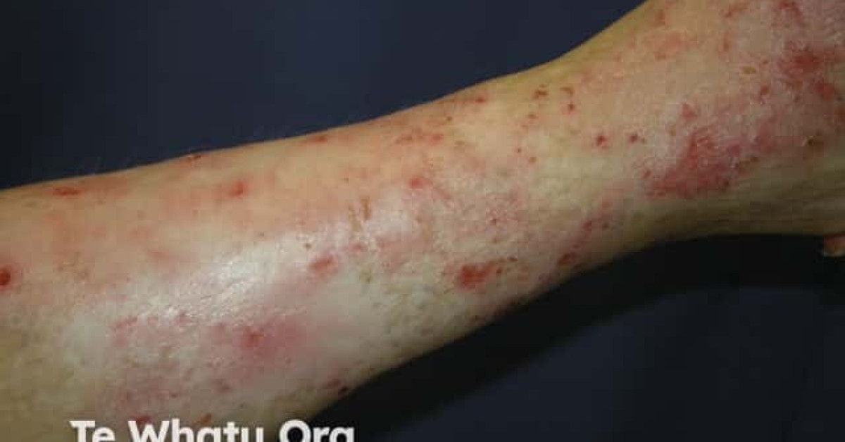 Venous Eczema Image 7290
