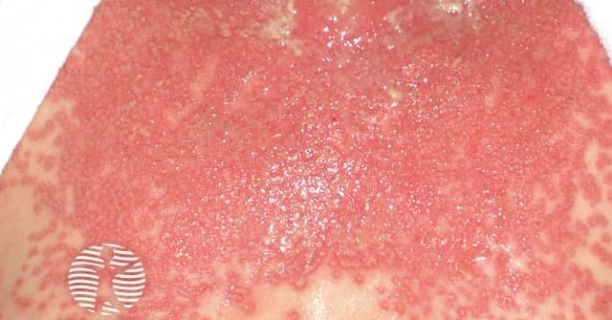 Eczema herpeticum image