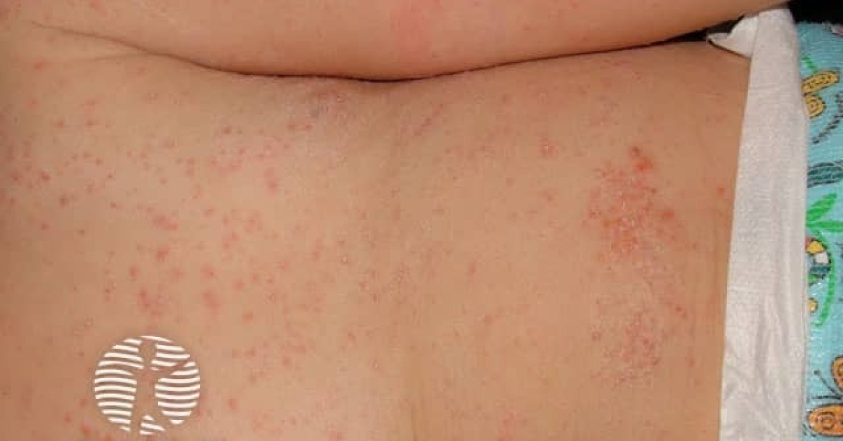 Viral exanthem image