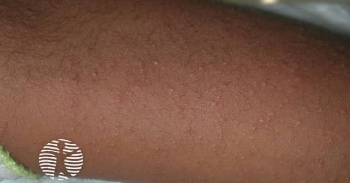 Viral exanthem image