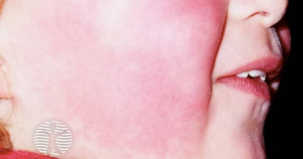 Erythema infectiosum image