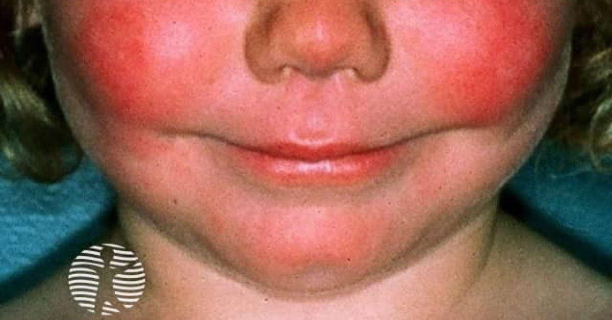 Erythema infectiosum image